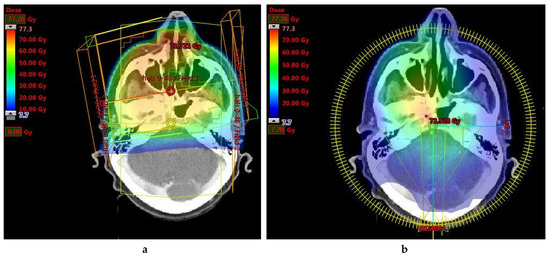 Can Intensity-Modulated-Radiotherapy Reduce Toxicity in Head and Neck ...