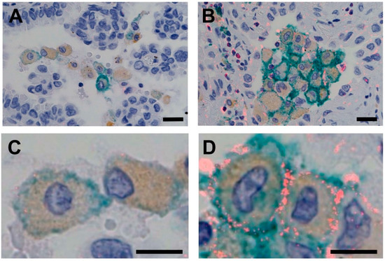 CSF1R-Expressing Tumor-Associated Macrophages, Smoking and Survival in ...
