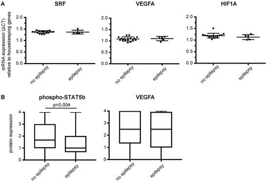 Epilepsy Associates with Decreased HIF-1α/STAT5b Signaling in Glioblastoma