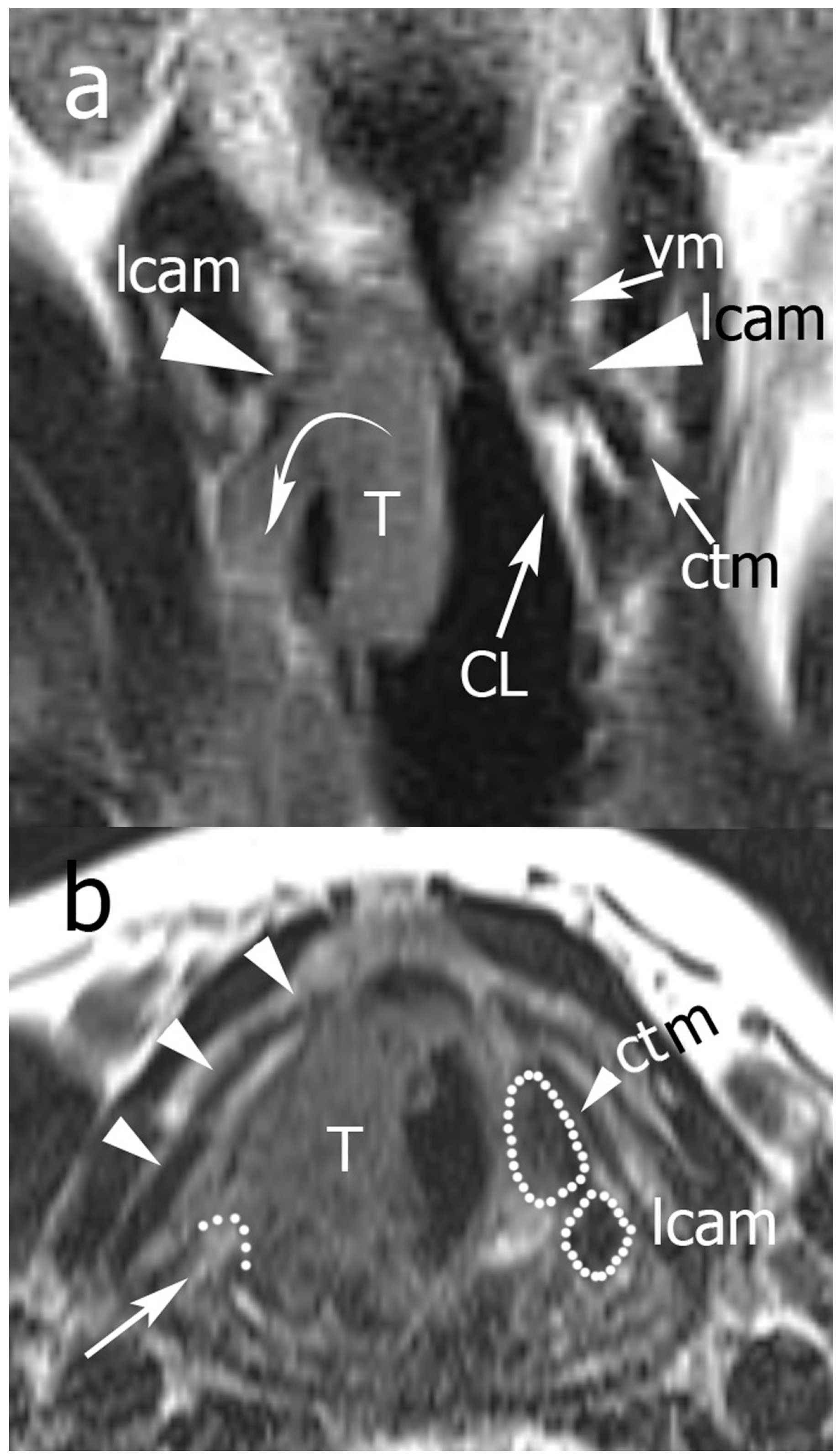 Prediction of Posterior Paraglottic Space and Cricoarytenoid Unit ...