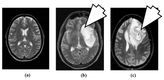 A Review on a Deep Learning Perspective in Brain Cancer Classification