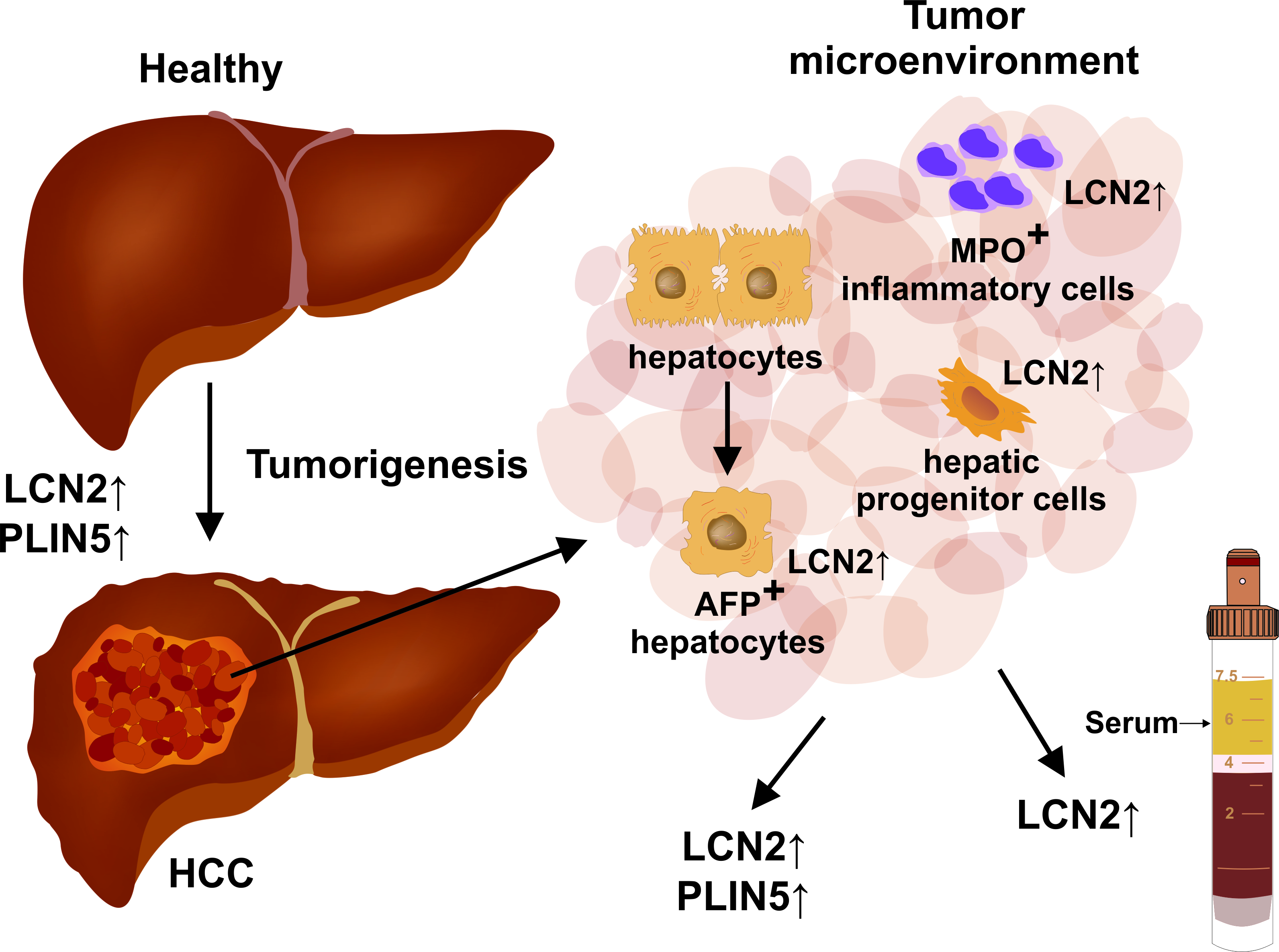 Cancers | Free Full-Text | Perilipin 5 and Lipocalin 2 Expression in ...