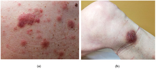 Blastic Plasmacytoid Dendritic Cell Neoplasm: State of the Art and ...