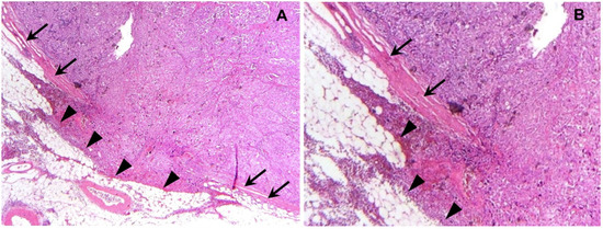 Extracapsular Lymph Node Involvement in Ovarian Carcinoma