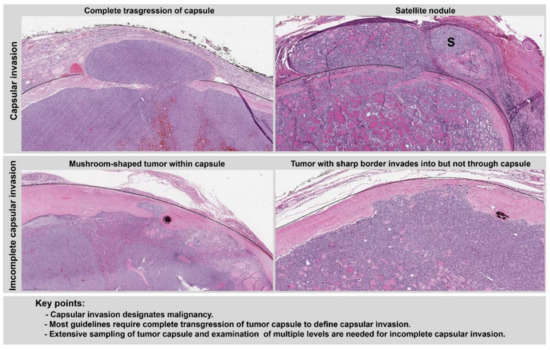 Critical Prognostic Parameters in the Anatomic Pathology Reporting of ...