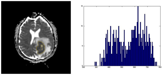 Whole Tumor Histogram Analysis Using DW MRI in Primary Central Nervous System Lymphoma ...