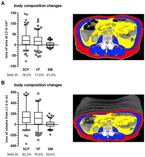 Cachectic Body Composition and Inflammatory Markers Portend a Poor ...