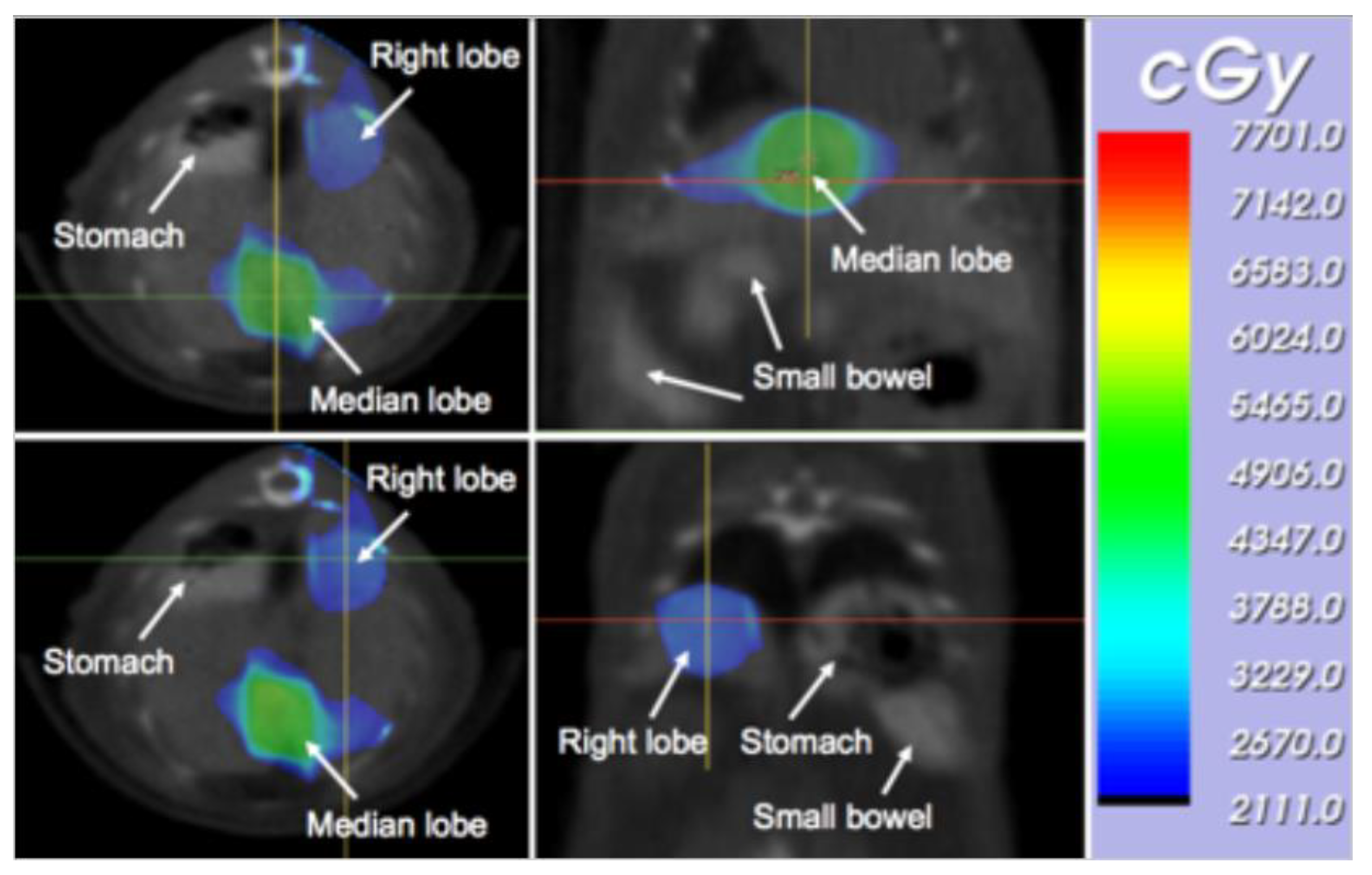 Non-Invasive Targeted Hepatic Irradiation and SPECT/CT Functional ...