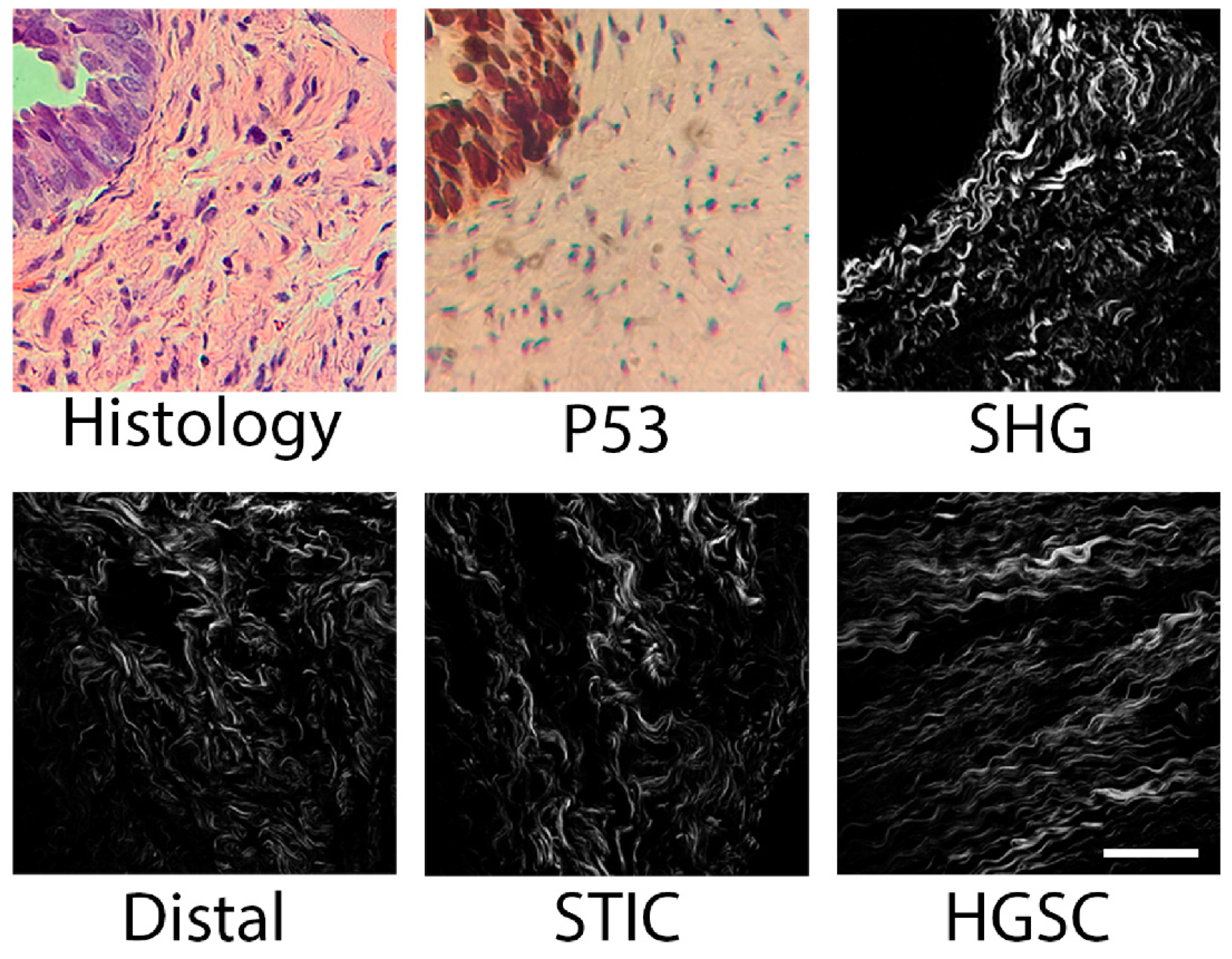 Imaging Collagen Alterations in STICs and High Grade Ovarian Cancers in ...