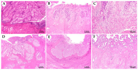 Myoinvasive Pattern as a Prognostic Marker in Low-Grade, Early-Stage ...
