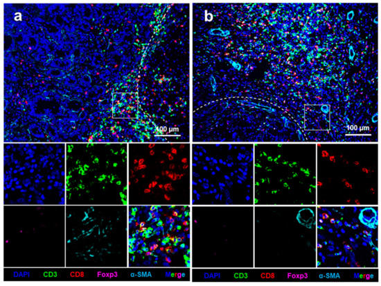 Cancers | Free Full-Text | Immune Cell Infiltration in the ...