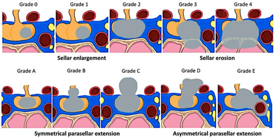 Pituitary Adenomas and Invasiveness from Anatomo-Surgical, Radiological ...