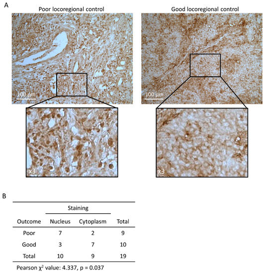 ACLY (ATP Citrate Lyase) Mediates Radioresistance in Head and Neck ...