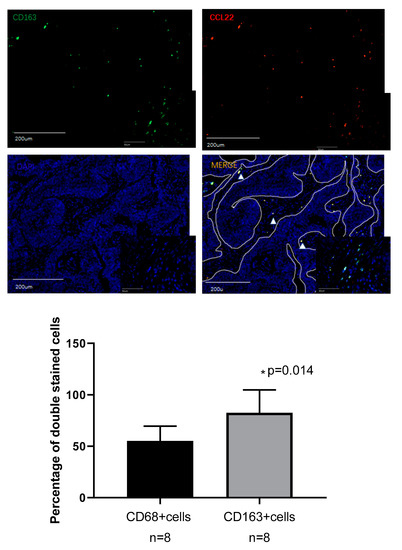 Higher CCL22+ Cell Infiltration is Associated with Poor Prognosis in ...