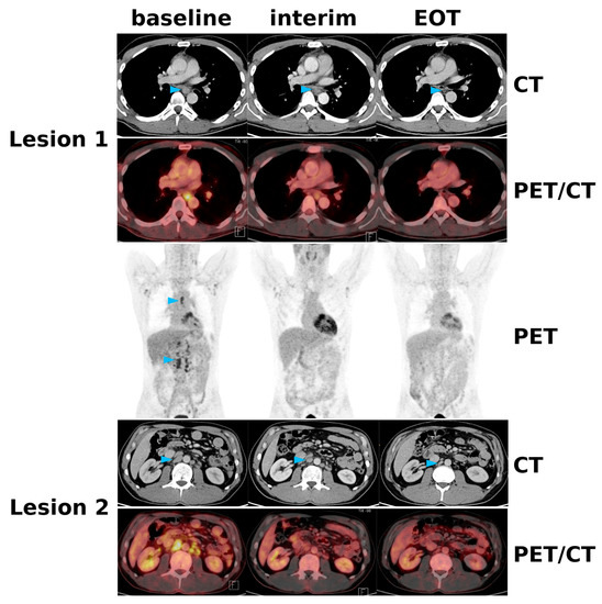 RECIL Versus Lugano for Treatment Response Assessment in FDG-Avid Non ...