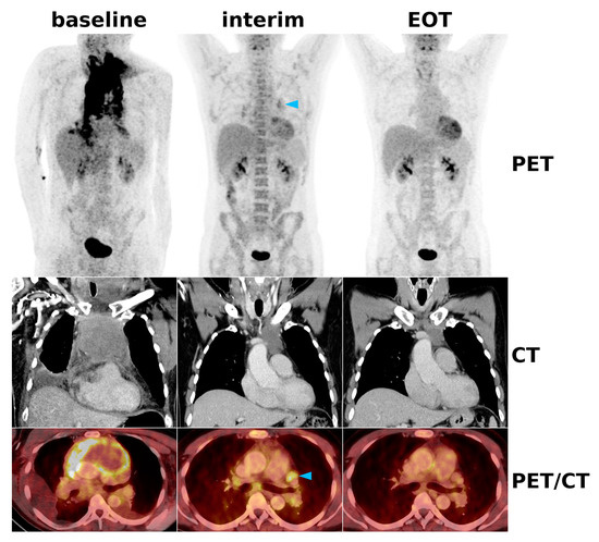RECIL Versus Lugano for Treatment Response Assessment in FDG-Avid Non ...