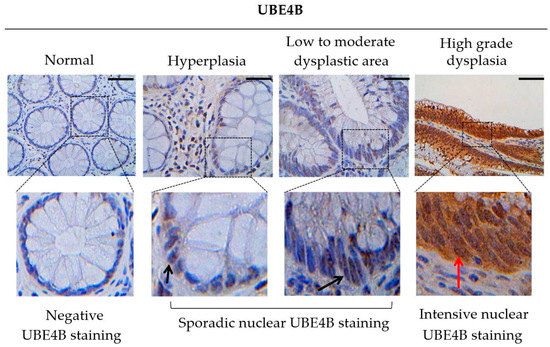 The Role of E3, E4 Ubiquitin Ligase (UBE4B) in Human Pathologies