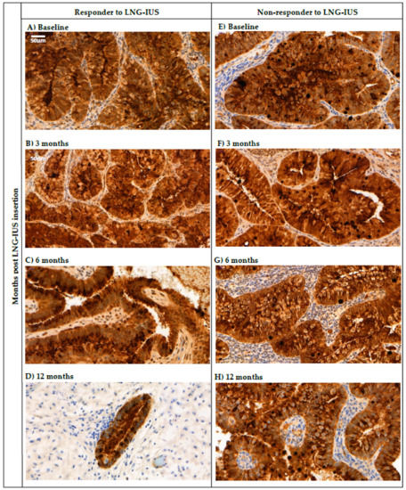 Baseline Serum HE4 But Not Tissue HE4 Expression Predicts Response to ...