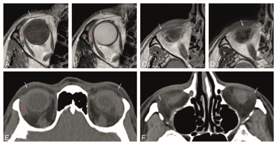 MR and CT Imaging of the Normal Eyelid and its Application in Eyelid Tumors