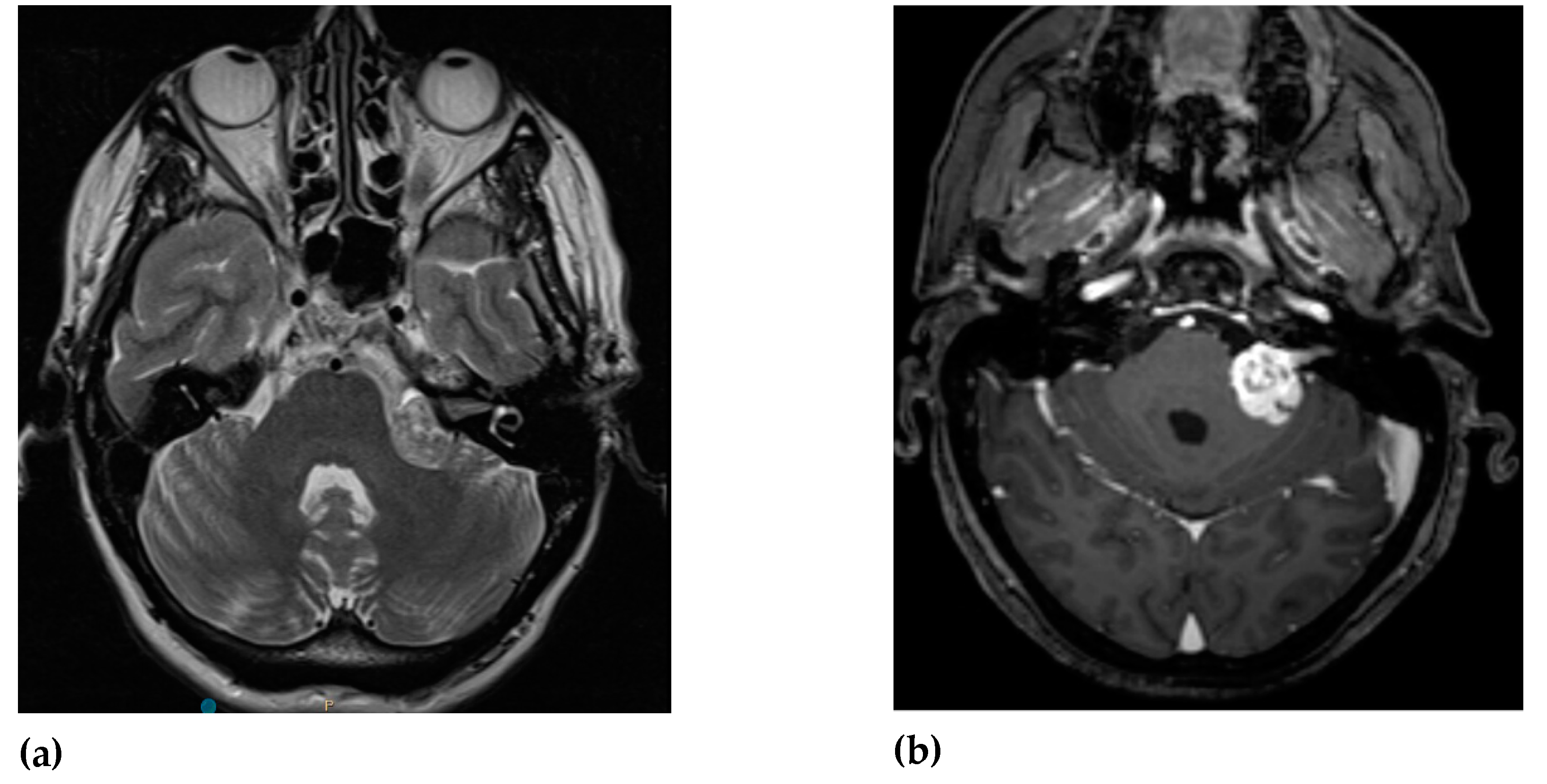 Neurofibromatosis Type 2 Mri