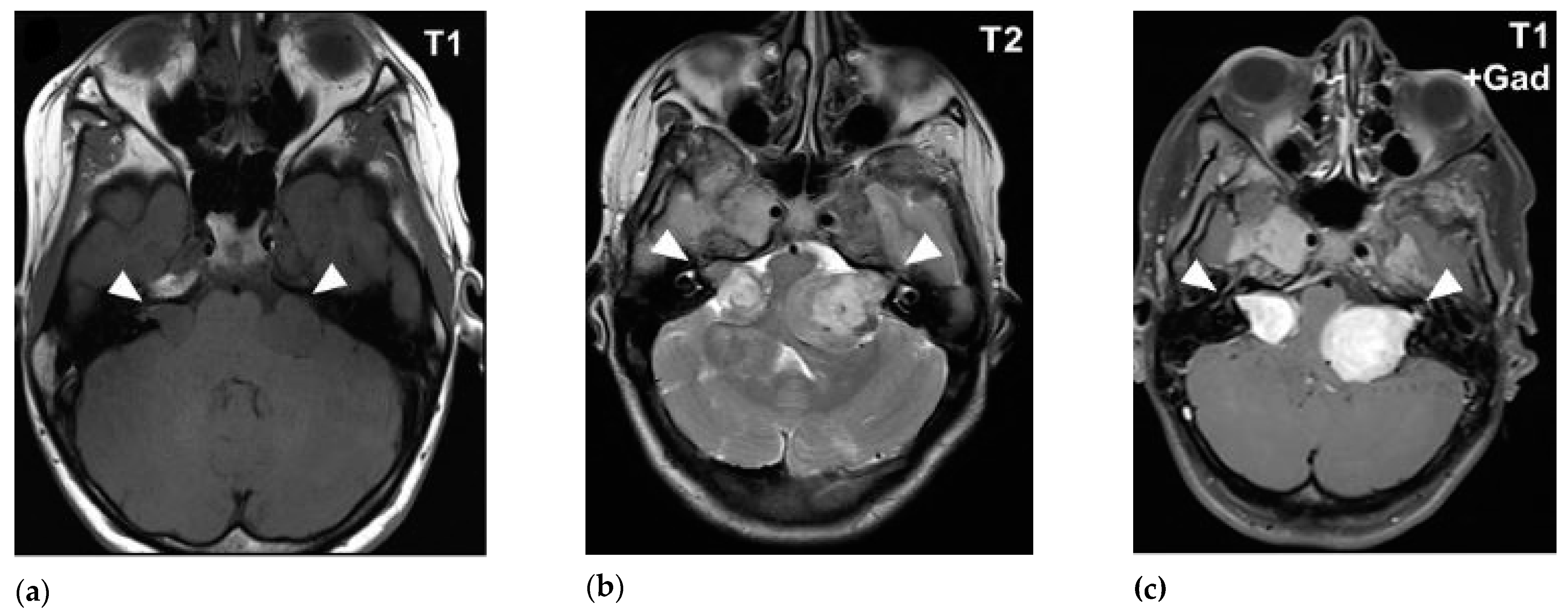 Neurofibromatosis Type 2 Mri