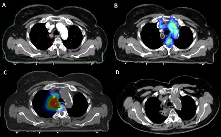 Cancers | Free Full-Text | Stereotactic Radiotherapy for Ultra-Central Lung Oligometastases in ...