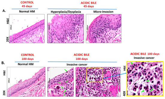 The Progressive Mutagenic Effects of Acidic Bile Refluxate in ...