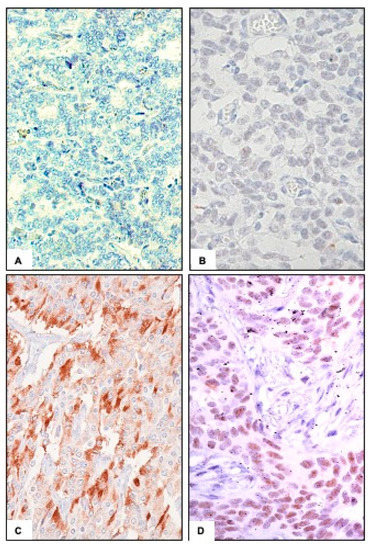 mTOR Pathway Expression as Potential Predictive Biomarker in Patients ...