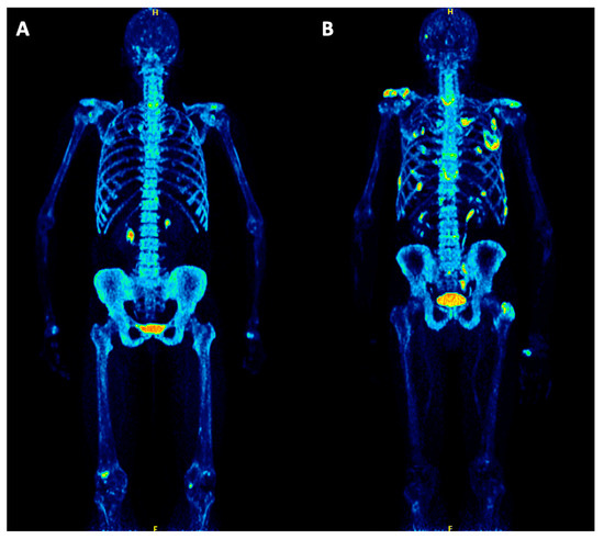 Can 18F-NaF PET/CT before Autologous Stem Cell Transplantation Predict ...