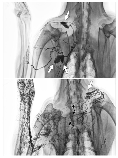 Anatomical Theories of the Pathophysiology of Cancer-Related Lymphoedema