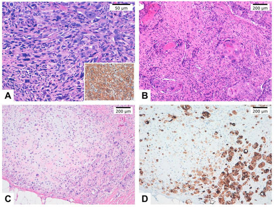 Molecular Features of Metaplastic Breast Carcinoma: An Infrequent ...