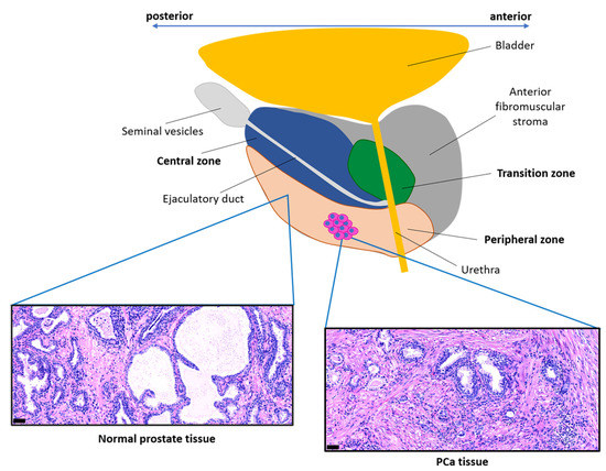 The Role of Cancer-Associated Fibroblasts in Prostate Cancer Tumorigenesis