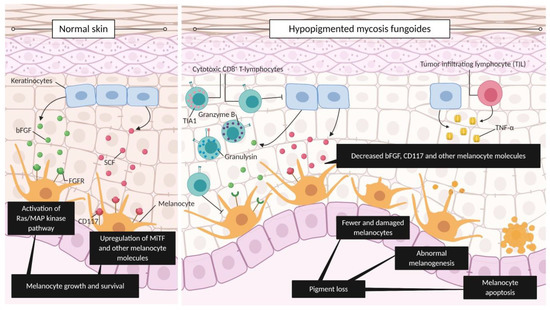Hypopigmented Mycosis Fungoides: Loss of Pigmentation Reflects ...