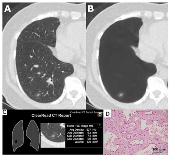 The Use of Artificial Intelligence in the Differentiation of Malignant ...
