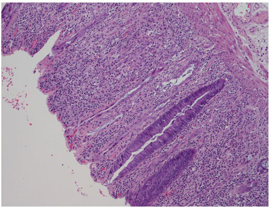 Acute Radiation Colitis after Preoperative Short-Course Radiotherapy ...