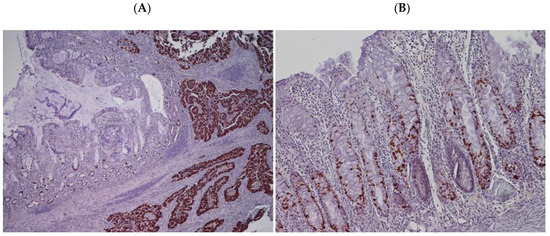 Acute Radiation Colitis after Preoperative Short-Course Radiotherapy ...