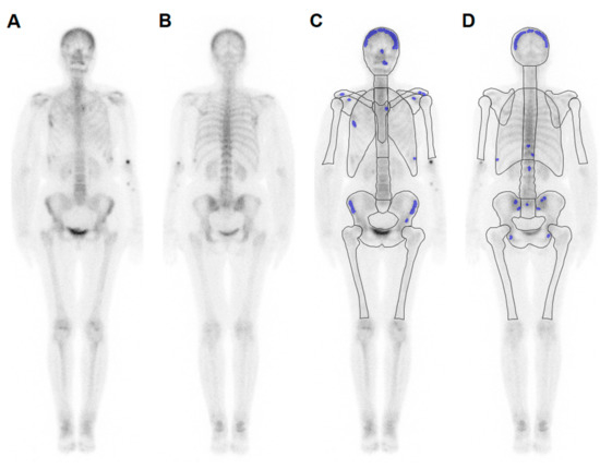 Analysis of Bone Scans in Various Tumor Entities Using a Deep-Learning ...