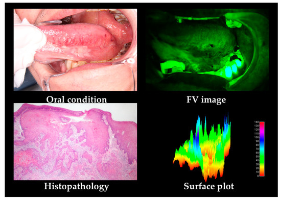 Non-Invasive Early Detection of Oral Cancers Using Fluorescence ...