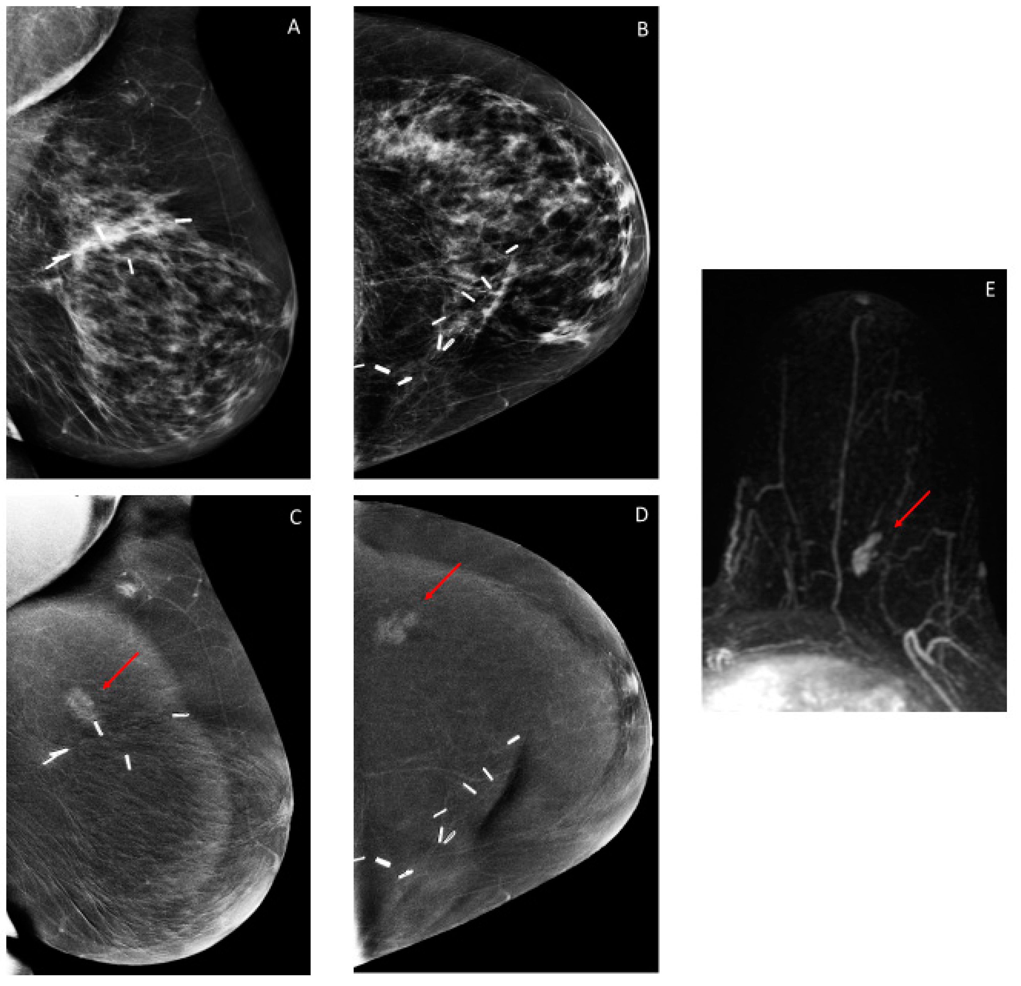 Cancers Free Full Text Contrast Enhanced Mammography For Screening
