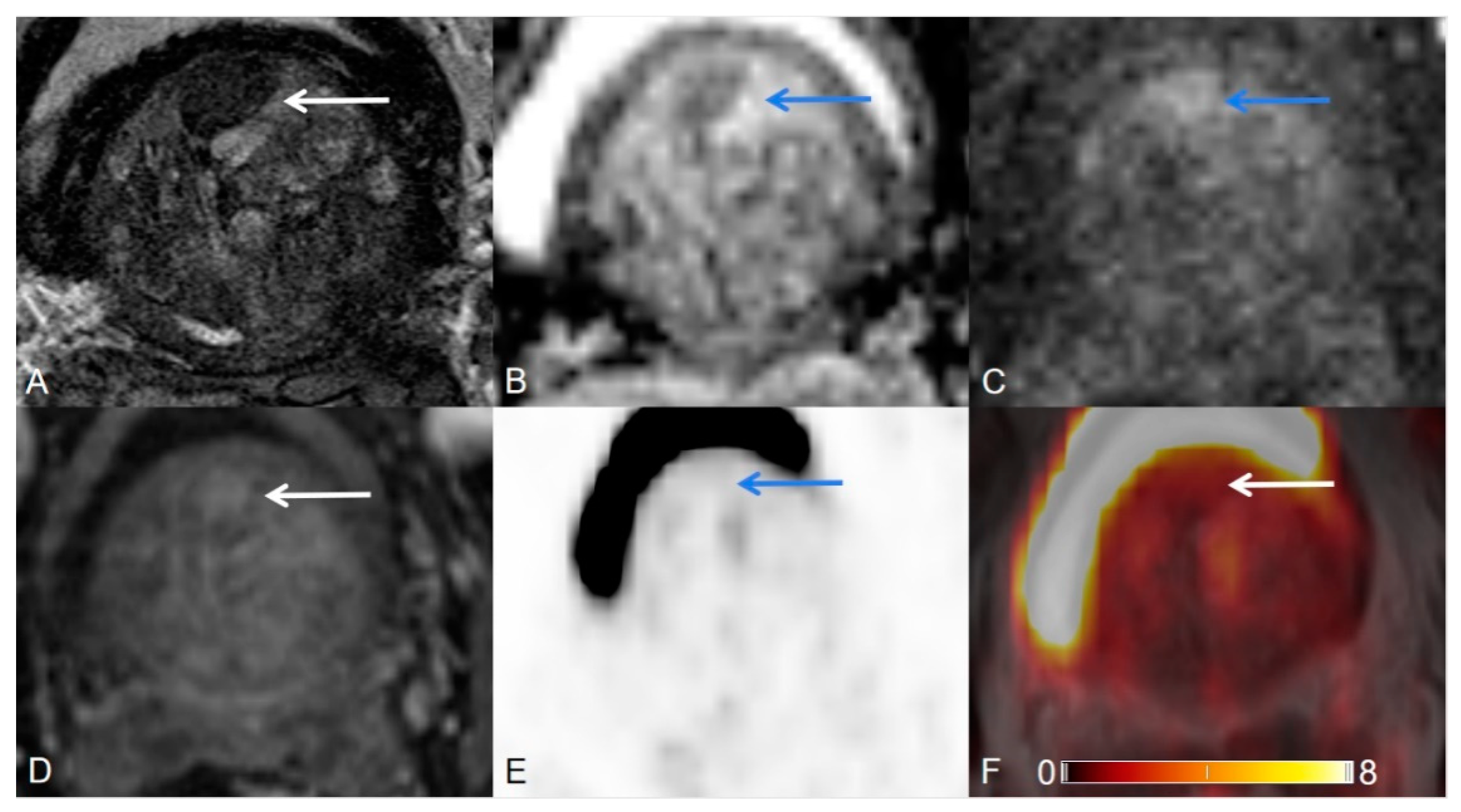 Correlation between Intraprostatic PSMA Uptake and MRI PI-RADS of [68Ga ...