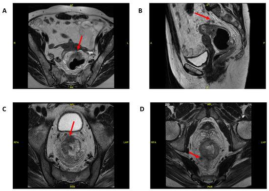 Neoadjuvant Chemotherapy in Locally Advanced Rectal Cancer