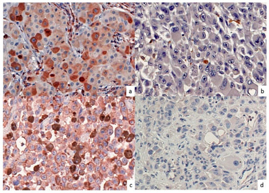 The Expression of CD74-Regulated Inflammatory Markers in Stage IV ...