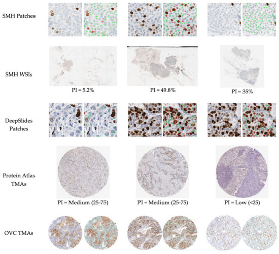 Cancers | Free Full-Text | piNET–An Automated Proliferation Index Calculator Framework for Ki67 ...