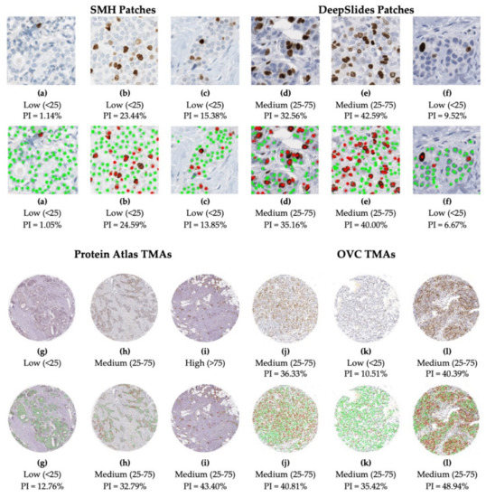 Cancers | Free Full-Text | piNET–An Automated Proliferation Index Calculator Framework for Ki67 ...