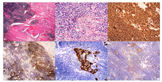 Primary Pulmonary B-Cell Lymphoma: A Review and Update