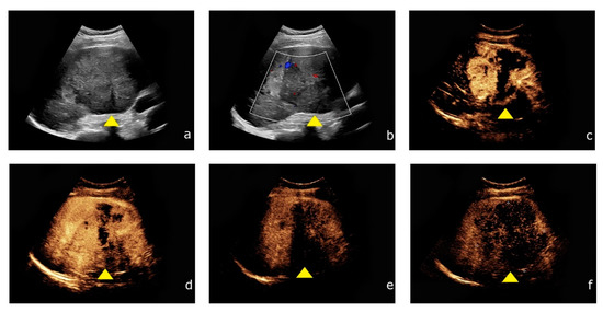 Structured Reporting Using CEUS LI-RADS for the Diagnosis of ...