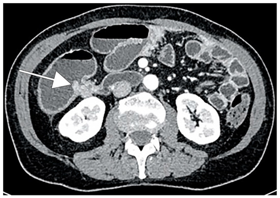 Where Does Primary Peritoneal Cancer Spread
