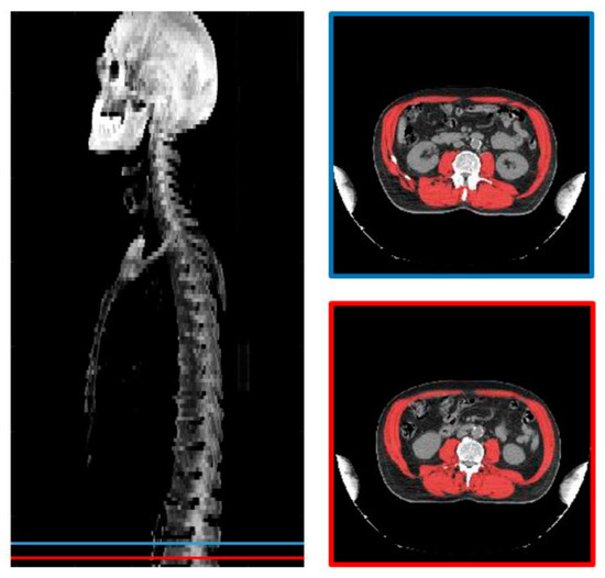 Cancers | Free Full-Text | Prospective Evaluation of Sarcopenia in Head ...