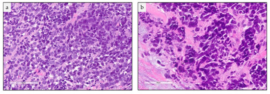 Pathology and Classification of SCLC