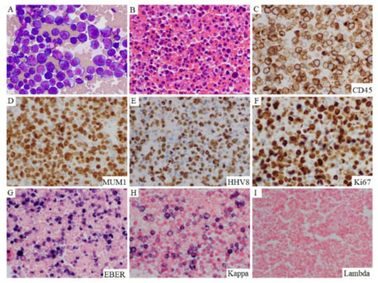 Primary Effusion Lymphoma: A Clinicopathological Study of 70 Cases